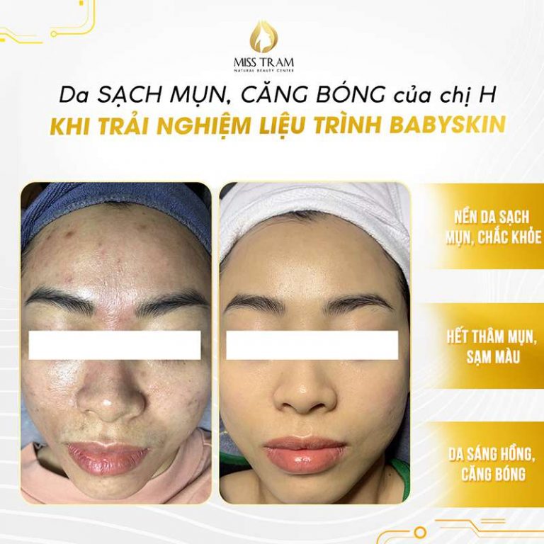 Làn Da Trắng Sáng, Mịn Màng Với Liệu Trình BABY SKIN 2026